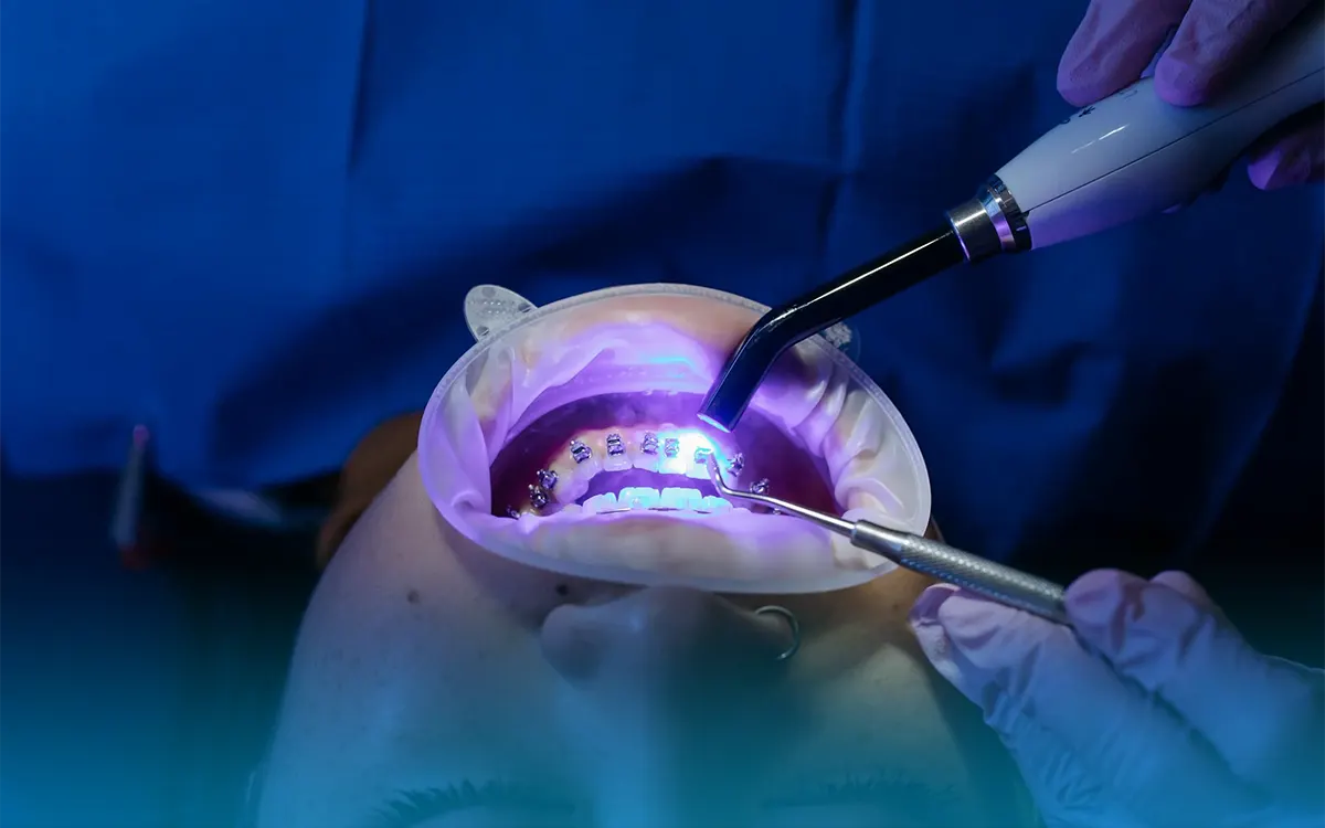 Prognatismo: cos'è e come influisce sulla salute orale